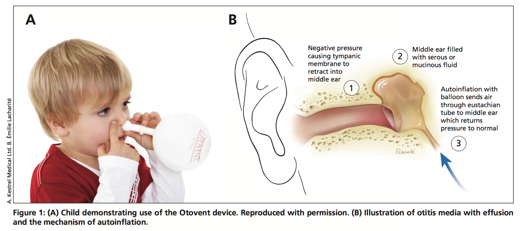 Illustration of otitis media with effusion and the mechanism of ...