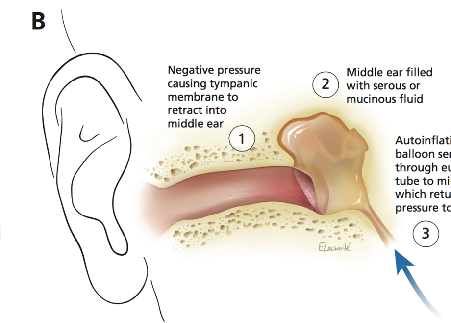 Illustration of otitis media with effusion and the mechanism of ...